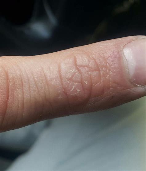 Трескается кожа на пальцах рук причины почему около ногтей портится кожа