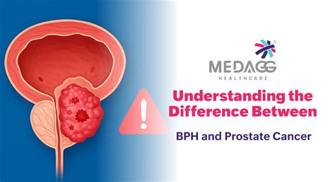 Can Varicocele Cause Erectile Dysfunction Understanding The Link Medagg