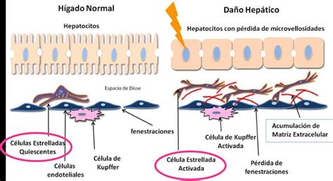 Nuevos Enfoques Para Frenar La Fibrosis Hepática Dciencia