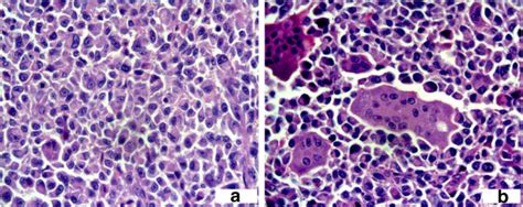 Three Multinuclear Giant Cells Surrounded By Neoplastic Mononuclear