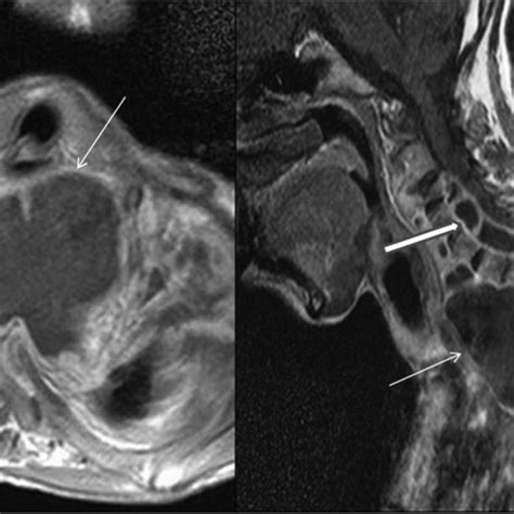 Magnetic Resonance Imaging Shows Pott Abscess Lysis Of The Vertebral