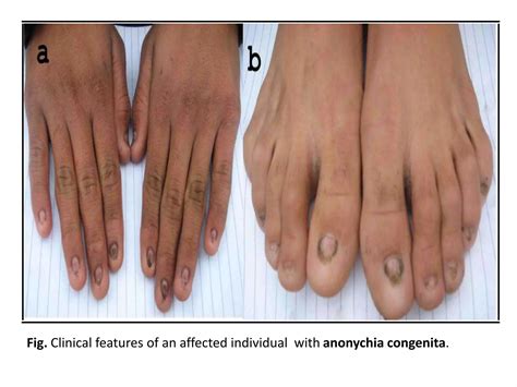 Ectodermal Dysplasias Genetic Disorder Pptx Skin And Dermatology Diseases And Conditions