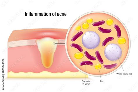 Acne On The Skin And A Magnified View Of The Bacteria That Cause Acne Vector For Advertising