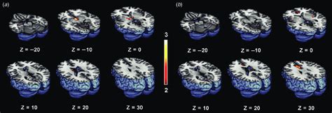Brain Activation Patterns Showing Areas With A A Predominance Of Download Scientific Diagram