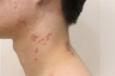 Neck Acne Causes Treatment And Prevention Guide
