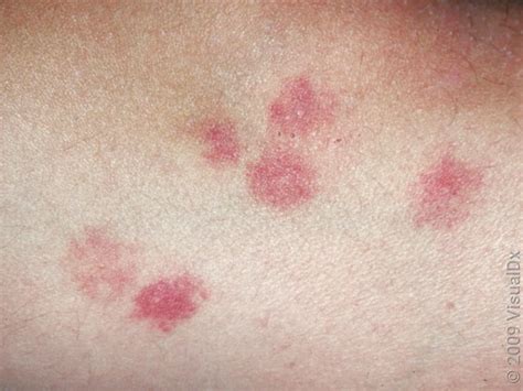 Close Up Pictures Of Bedbug Bites And Signs To Watch For Goodrx