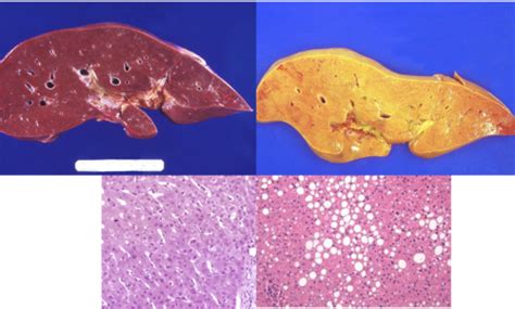 7 Intracellular Accumulations Flashcards Quizlet