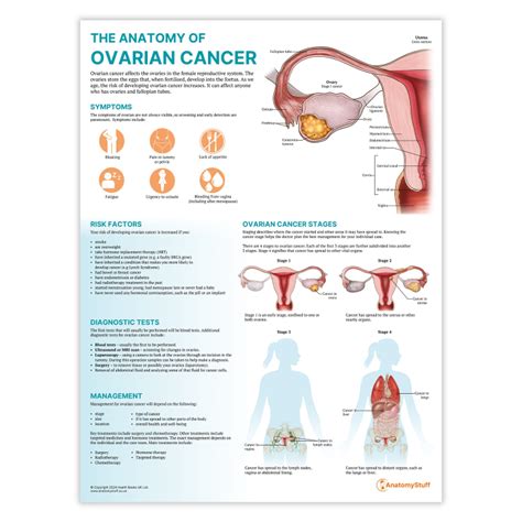 Ovarian Cancer A Visual Guide