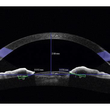 Repeatability Of Pentacam Ubm And As Oct In Measuring Acd C Icl And
