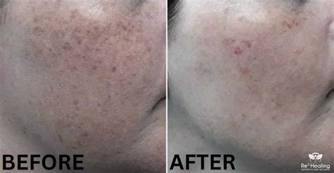 Hyperpigmentation In Sarasota Fl Center For Regenerative And Aesthetic Wellness