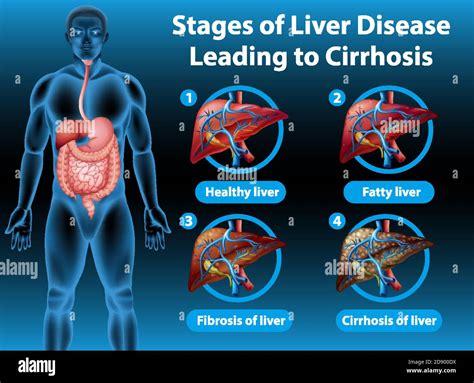 Stages Of Liver Disease Leading To Cirrhosis Illustration Stock Vector