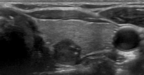 Transverse Ultrasound Image Of Thyroid Nodules Ultrasound Showing 0 8 Download Scientific