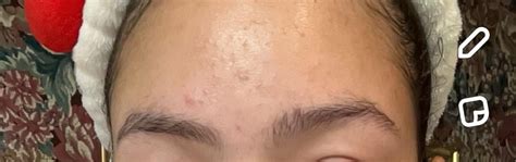 [routine Help] Prescribed Clindamycin And Doxycycline R Skincareaddiction