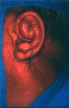Cauliflower Ear Causes Pictures Draining And Treatment