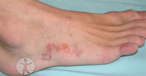 Cutaneous Larva Migrans Image