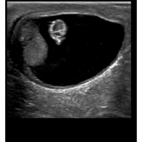 Doppler Ultrasonography Revealed No Blood Flow To The Appendix Testis