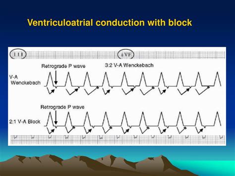 Ppt Approach To Wide Qrs Complex Tachycardia Powerpoint Presentation Id 771250