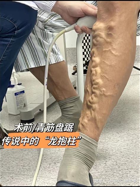 静脉曲张专家杨希亭发生静脉曲张后腿部会有哪些变化 知乎