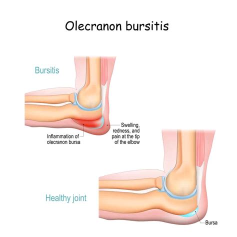 Olecranon Bursectomy