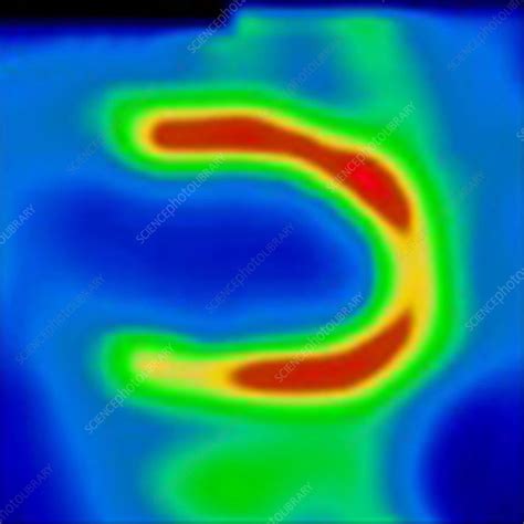 Heart Attack Spect Scan Stock Image C050 0746 Science Photo Library