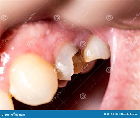 A Black Dead Tooth In Which A Piece Of Tooth Enamel Is Chipped Off A Tooth Chip The Concept Of