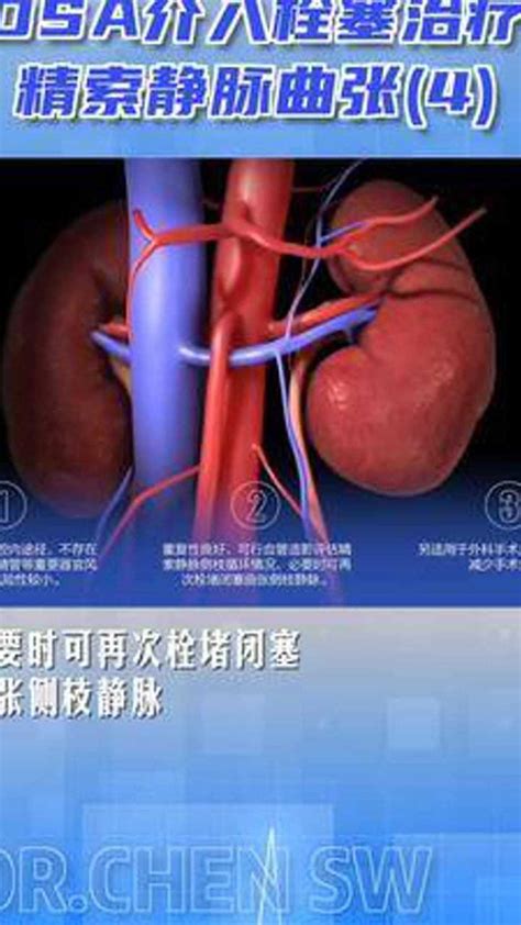 Dsa介入栓塞治疗精索静脉曲张 4 介入栓塞的优势 精索静脉曲张 高清1080p在线观看平台 腾讯视频