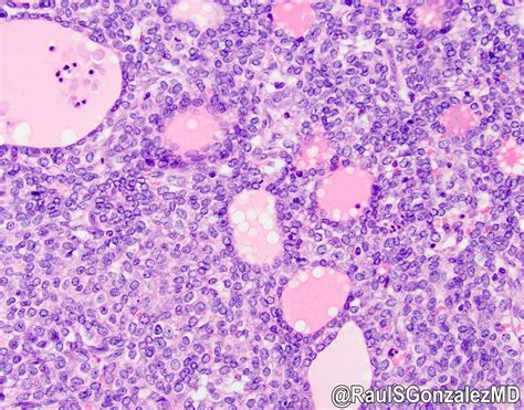 Cholangiocarcinoma Histology