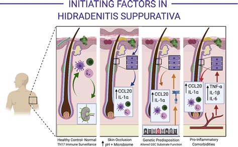 Initiating Factors In Hidradenitis Suppurativa Normal Control Skin