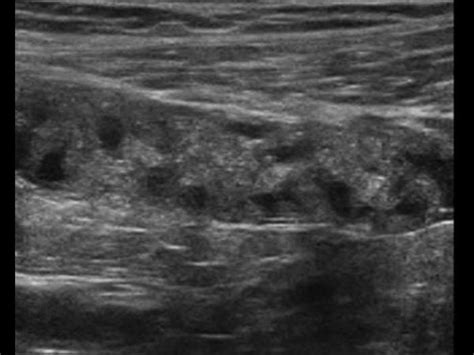 Abdomen And Retroperitoneum 1 5 Appendix Case 1 5 2 Uncomplicated Appendicitis Ultrasound