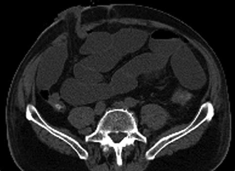 Ct And Mri Features Of Ileostomies Ajr