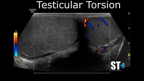 Testicularscrotal Doppler Protocol Sonographic Tendencies