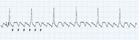 Atrial Flutter Fluter Atrial Jantung Oke