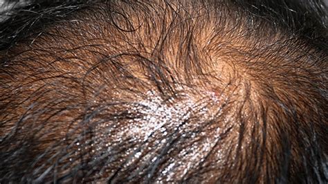 3 Common Types Of Scalp Problems Tricholab