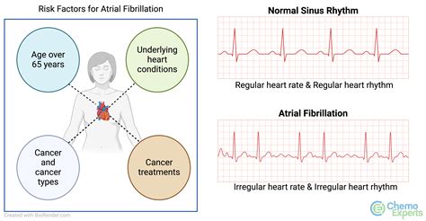 Atrial Fibrillation Chemoexperts