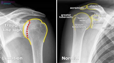 Humerus X Ray