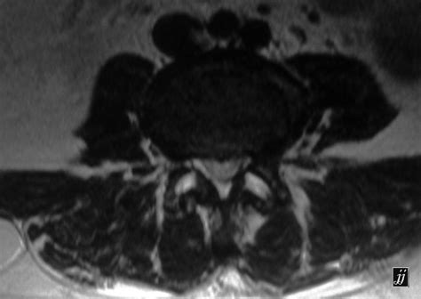 Spine Facet Joint Effusion And Lateral Perineural Cyst 21 Radioogle