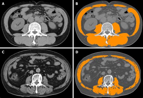 Computed Tomography Modality And Skeletal Muscle Index A And C Download Scientific Diagram
