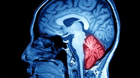 Cerebellar Tonsillar Ectopia Longhorn Brain And Spine