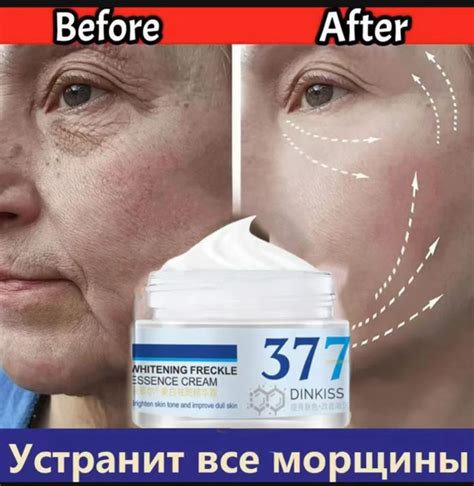 Крем отбеливающий для лица против пигментации и пигментных пятен от веснушек комплексного