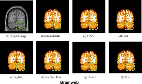 Figure 5 From Graph Neural Network And Superpixel Based Brain Tissue