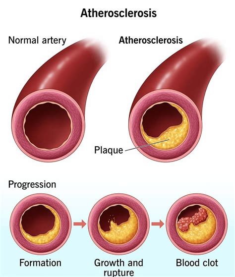 Plaque Symptoms Causes Treatment My Health And Fitness