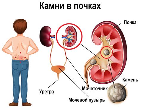 Лечение Камней В Почках Фото —