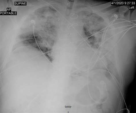 Cxr On Admission Showing Diffuse Bilateral Infiltrates Involving Almost Download Scientific
