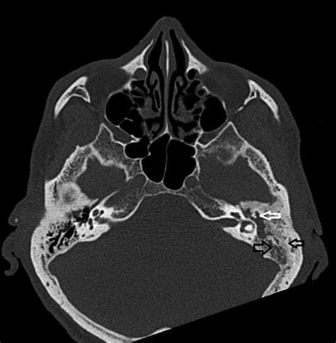 High Resolution Ct Of Temporal Bone Sclerosis Of The Temporal Bone