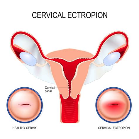 Cervical Ectropion Dr Nitu Bajekal