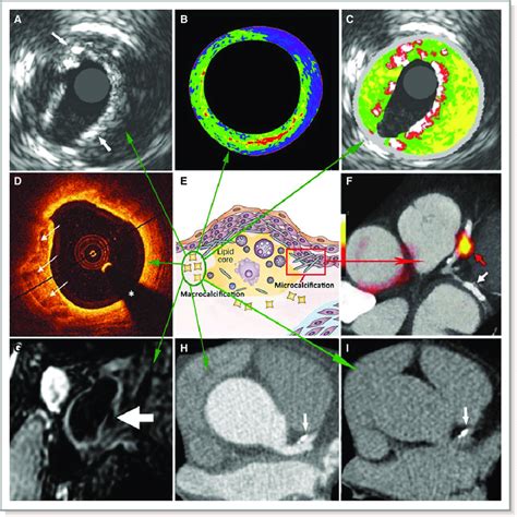 Multimodality Imaging Of Cardiovascular Calcification Representative