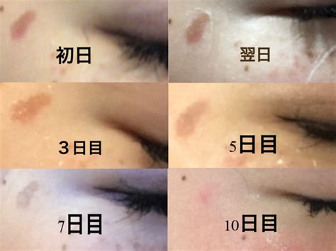 【オススメ】シミ取りレーザーを当てたその後の気になる経過！ マキアオンライン 美容雑誌『maquia（マキア）』公式ビューティサイト
