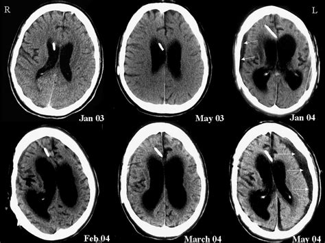 Serial Ct Scans Of Patient 1 Demonstrating Sequential Occurrence Of