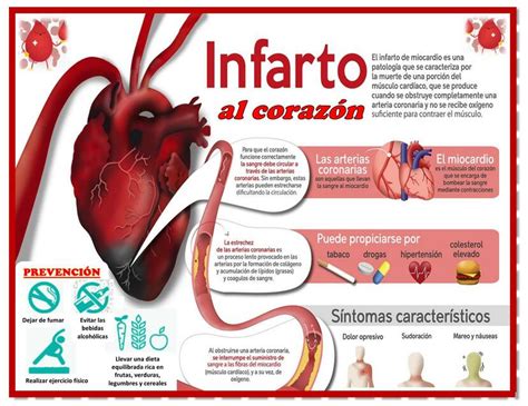 Infografia De Infarto Al Corazon Chioisabella Adrian Udocz