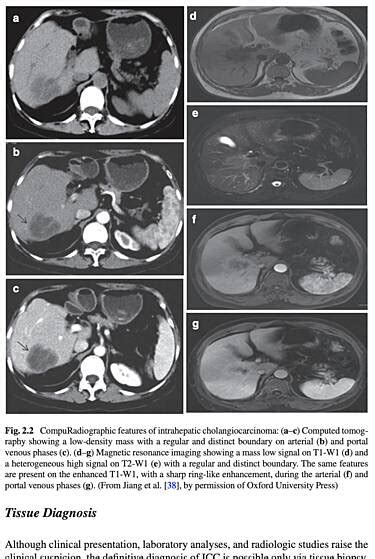 Cholangiocarcinome Intrahépatique • Publication • Site Médical Medtubefr